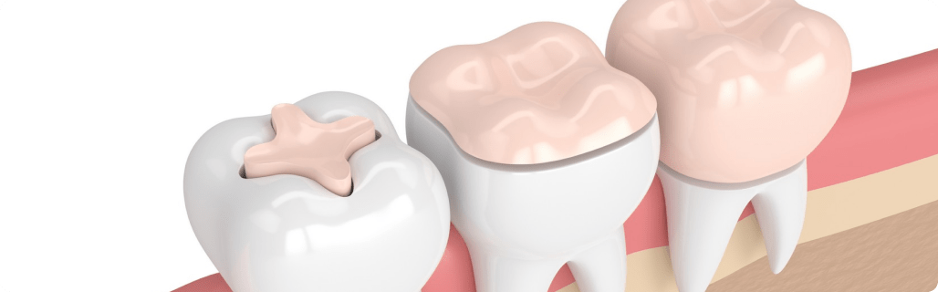 L'inlay/Onlay | Cabinet Ecoparc Nord à Norroy le Veneur