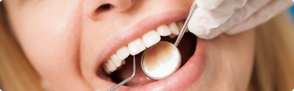 La carie dentaire | Chirurgien-Dentiste Dr Antoniacomi | Metz